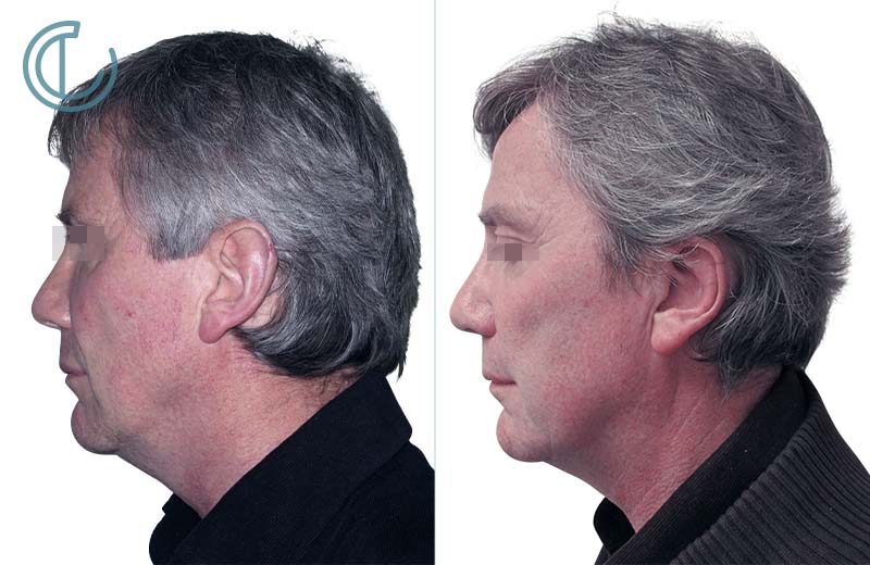 Photos chirurgie dermatologique Avant/Apres | Centre SurgiSkin | Paris