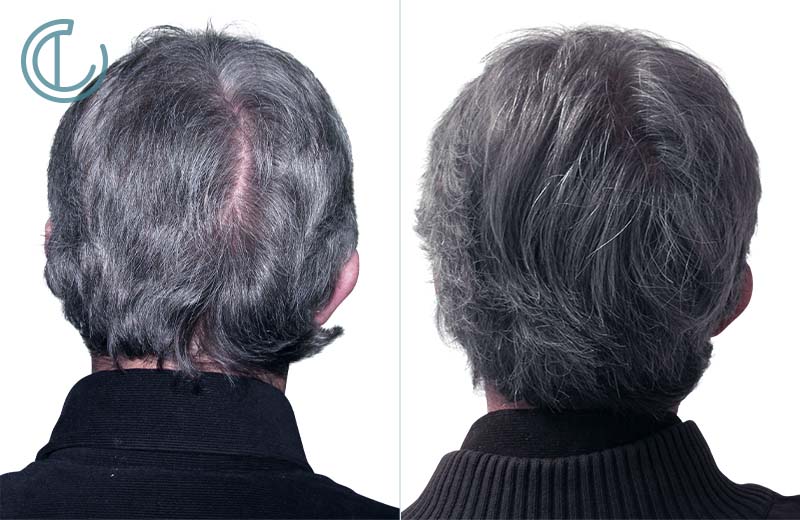 Photos chirurgie dermatologique Avant/Apres | Centre SurgiSkin | Paris