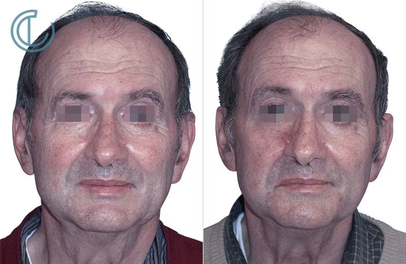 Photos chirurgie dermatologique Avant/Apres | Centre SurgiSkin | Paris