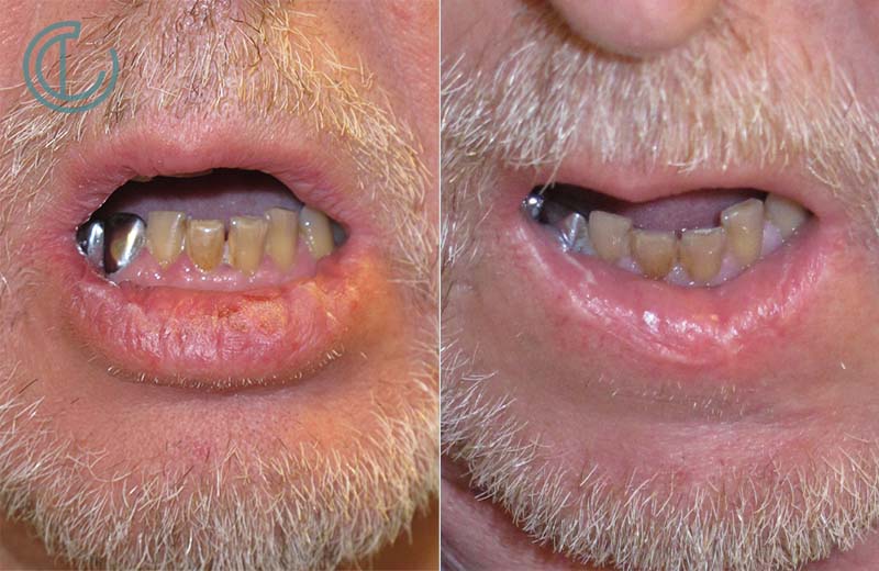 Photos chirurgie dermatologique Avant/Apres | Centre SurgiSkin | Paris