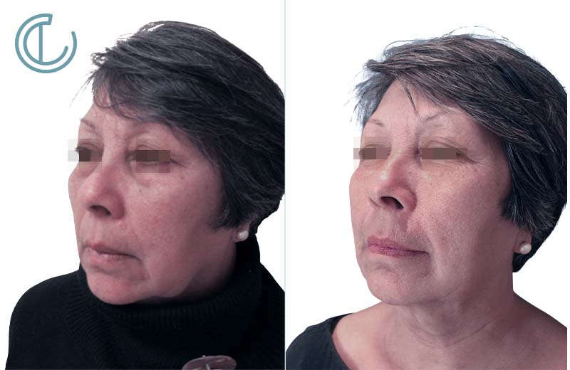 Photos chirurgie dermatologique Avant/Apres | Centre SurgiSkin | Paris