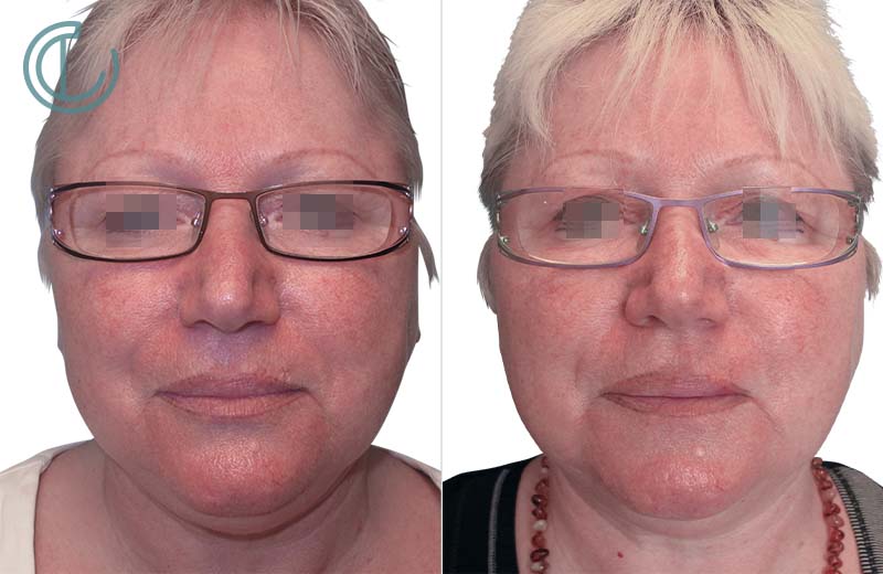 Photos chirurgie dermatologique Avant/Apres | Centre SurgiSkin | Paris