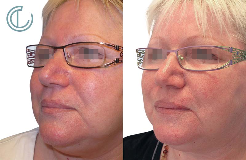 Photos chirurgie dermatologique Avant/Apres | Centre SurgiSkin | Paris