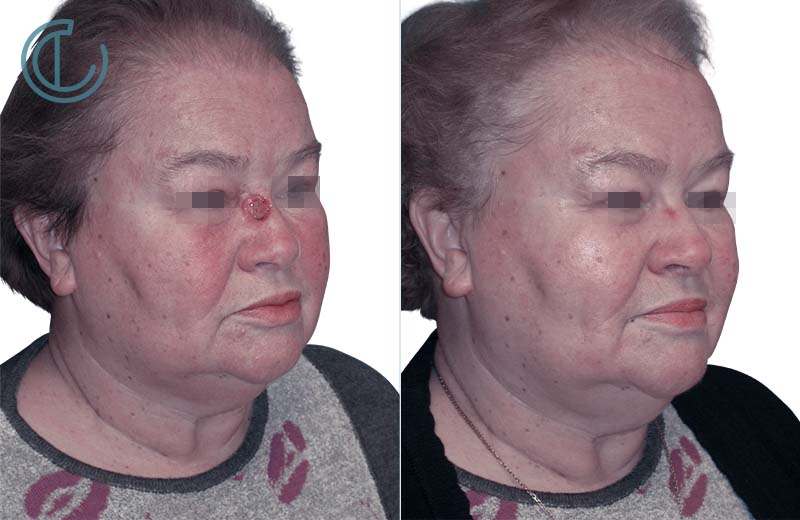 Photos chirurgie dermatologique Avant/Apres | Centre SurgiSkin | Paris