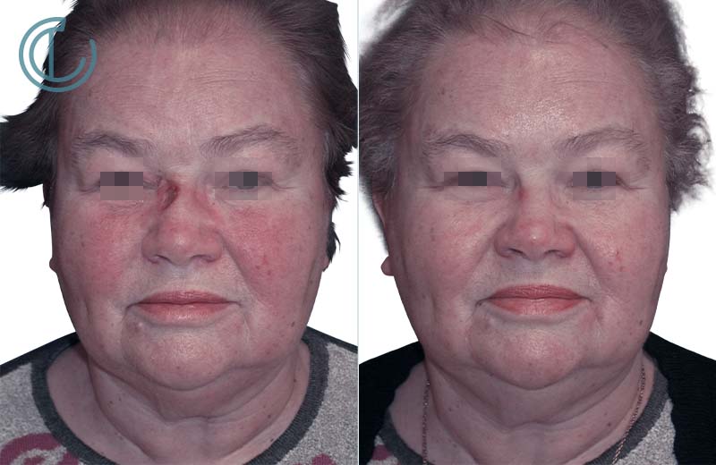 Photos chirurgie dermatologique Avant/Apres | Centre SurgiSkin | Paris