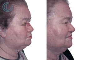 Photos chirurgie dermatologique Avant/Apres | Centre SurgiSkin | Paris