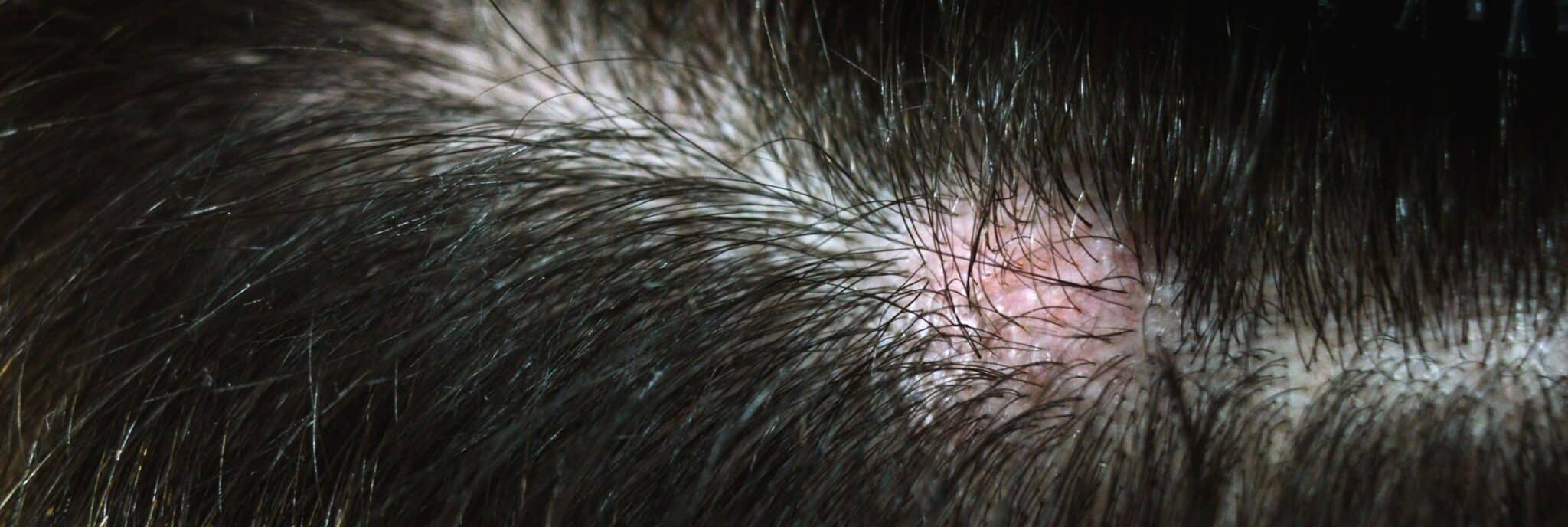 Retrait d'un kyste sur la tête : faut-il se raser ? | Centre chirurgie ...