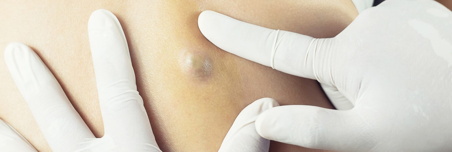 Kystes cutanés : quelles sont les causes ? | Centre chirurgie ...